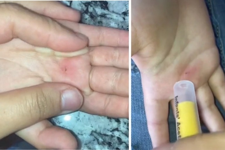 How to Remove a Splinter - This Hack is a Game Changer for Parents!