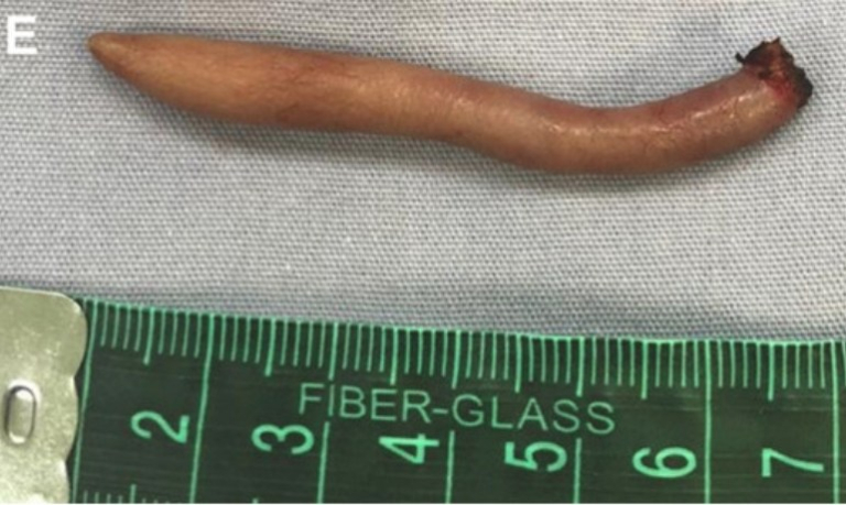 Newborn Baby Girl with Extremely Rare Tail | Mum Central