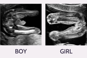 4 Ways to Determine the Gender on Ultrasound Scans - Is it a Boy or Girl?